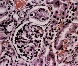 Pathology Outlines - CMV
