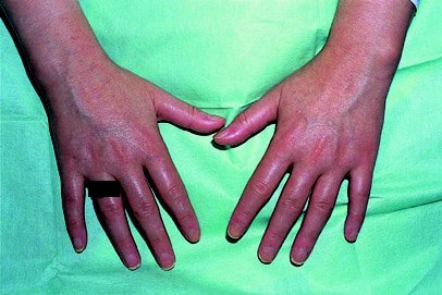 Affected by Lupus or a MCTD? Tell your story